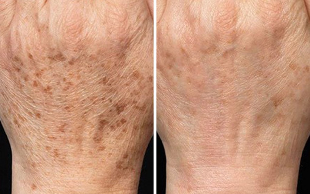 Cryotherapy With Cryopen™ Renew Medical Aesthetics Cheshire Clinic